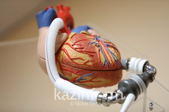 Dunyoda ilk bor: qozoq shifokorlari sun’iy yurakni donor yuragiga ...